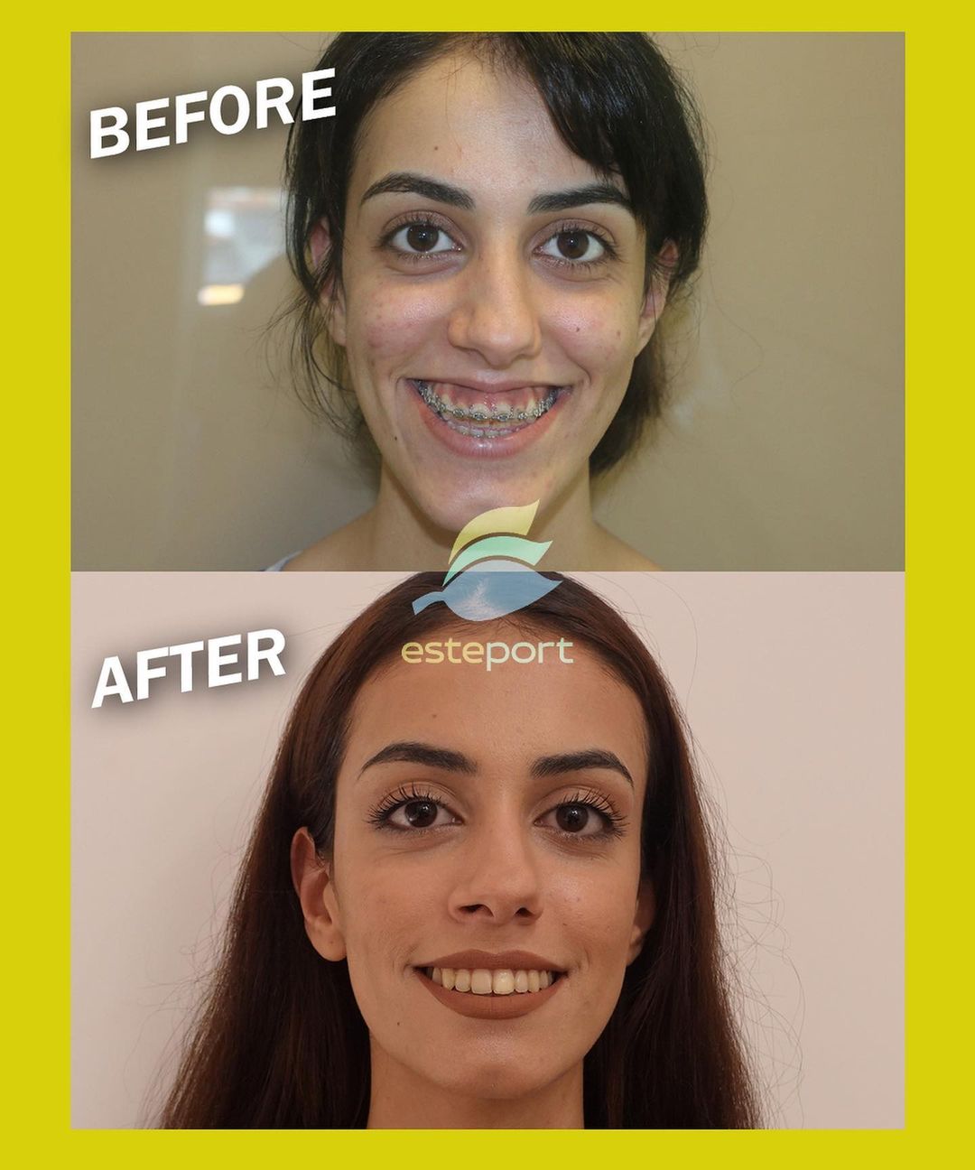 Jaw Surgery Turkey - Orthognathic - Dr. Ali Mezdeği - Istanbul
